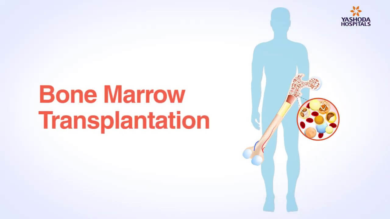 transplantacija koštane srži | Trendovi u medicini, Zdravlje i ...